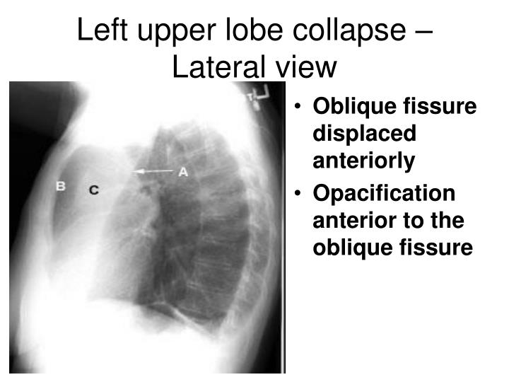 PPT - Tension hydropneumothorax PowerPoint Presentation - ID:4813077