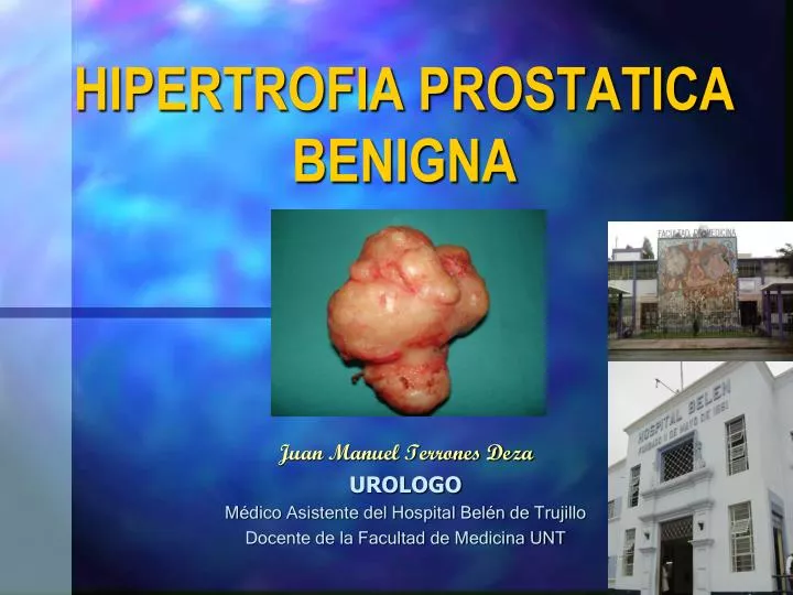 PPT - HIPERTROFIA PROSTATICA BENIGNA PowerPoint Presentation, free ...