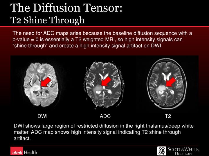 PPT - Technical Considerations in Brain DWI: PowerPoint Presentation ...