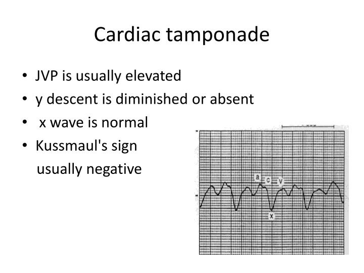 PPT - Jugular venous pressure and waveforms PowerPoint Presentation - ID:4817574