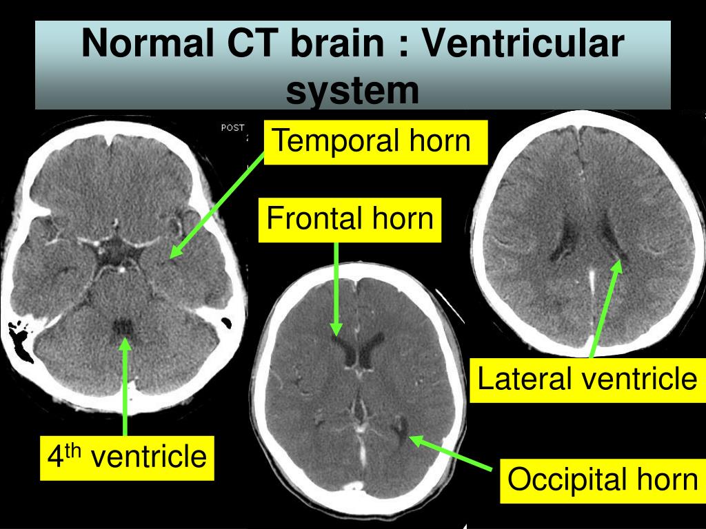 Ventricular System Ventricular System