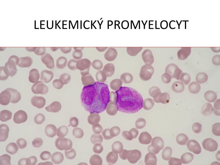 PPT - Diferenciální diagnostika leukocytóz v morfologické laboratoři ...