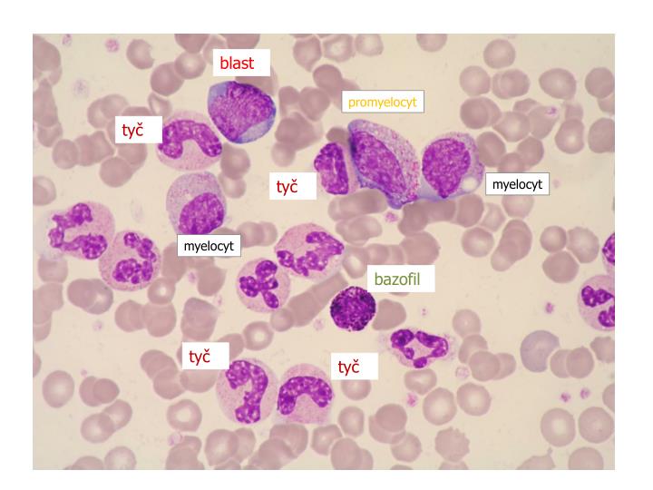 PPT - Diferenciální diagnostika leukocytóz v morfologické laboratoři ...