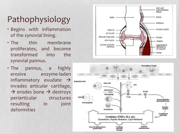 PPT - RHEUMATOID ARTHRITIS PowerPoint Presentation - ID:4829023