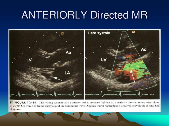 PPT - MITRAL REGURGITATION PowerPoint Presentation - ID:4829843