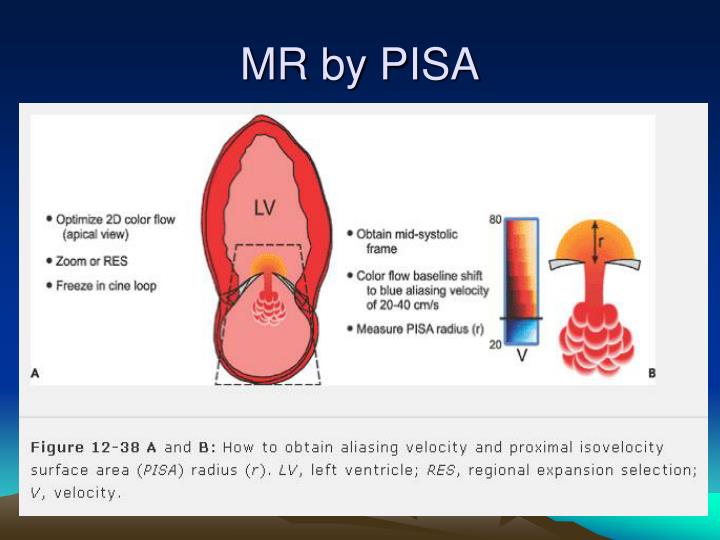PPT - MITRAL REGURGITATION PowerPoint Presentation - ID:4829843
