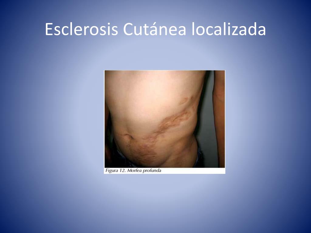 PPT - Manifestaciones Cutáneas de Enfermedades Reumáticas PowerPoint ...