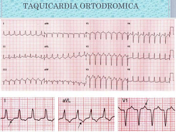 PPT - Abordaje de Tq supraventricular en servicio de urgencias ...