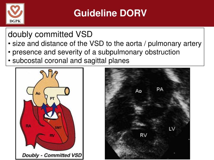 PPT - DGPK guideline Double Outlet Right Ventricle (DORV) PowerPoint ...
