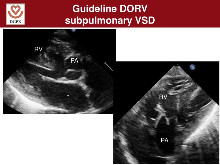 PPT - DGPK guideline Double Outlet Right Ventricle (DORV) PowerPoint ...
