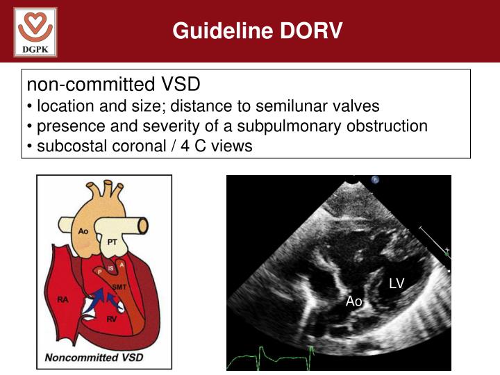 PPT - DGPK guideline Double Outlet Right Ventricle (DORV) PowerPoint ...