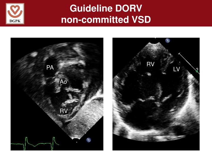 PPT - DGPK guideline Double Outlet Right Ventricle (DORV) PowerPoint ...