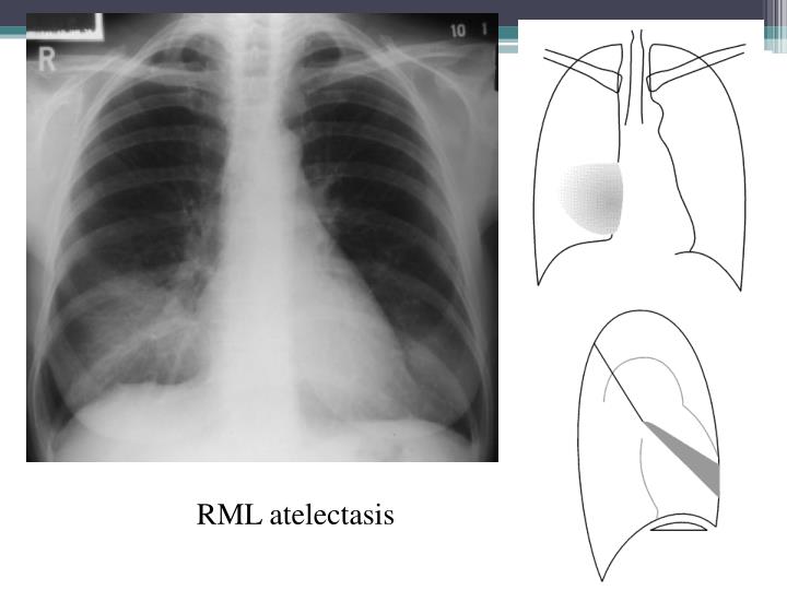 PPT - Atelectasis PowerPoint Presentation - ID:4838058