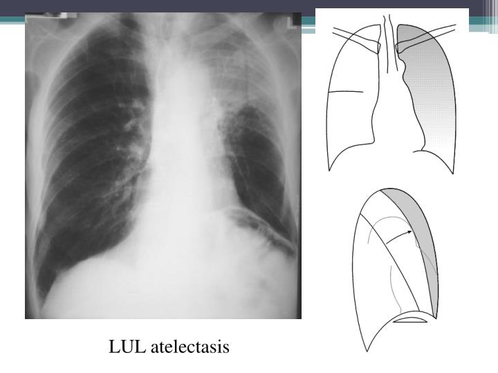PPT - Atelectasis PowerPoint Presentation - ID:4838058