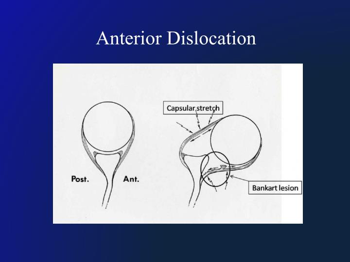 PPT - Shoulder Dislocation PowerPoint Presentation - ID:4841498