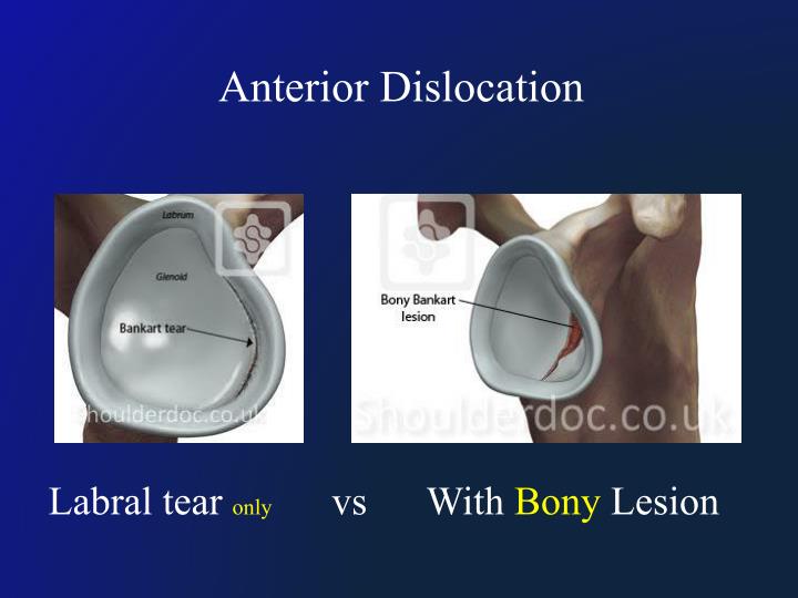PPT - Shoulder Dislocation PowerPoint Presentation - ID:4841498