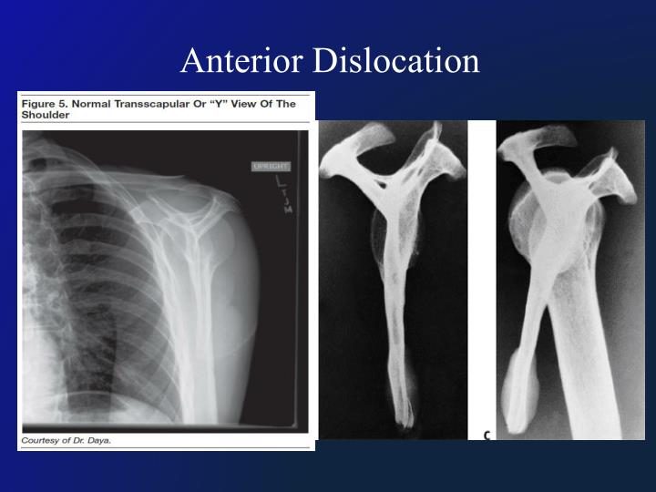 PPT - Shoulder Dislocation PowerPoint Presentation - ID:4841498