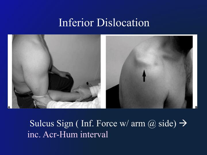 PPT - Shoulder Dislocation PowerPoint Presentation - ID:4841498