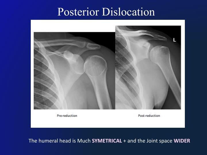 PPT - Shoulder Dislocation PowerPoint Presentation - ID:4841498