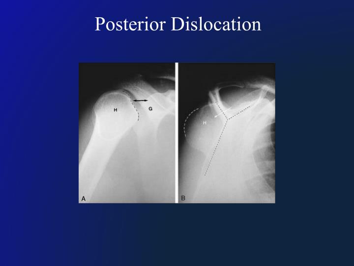 PPT - Shoulder Dislocation PowerPoint Presentation - ID:4841498