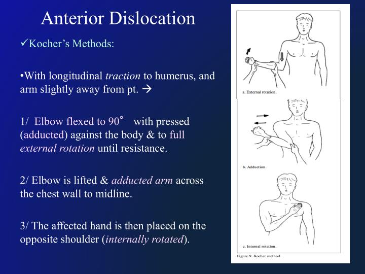 PPT - Shoulder Dislocation PowerPoint Presentation - ID:4841498
