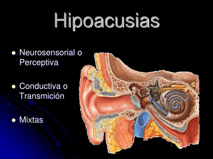 PPT - Hipoacusia y Audiometrias PowerPoint Presentation - ID:4841601