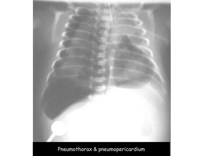 PPT - Pneumothorax & pneumopericardium PowerPoint Presentation, free ...
