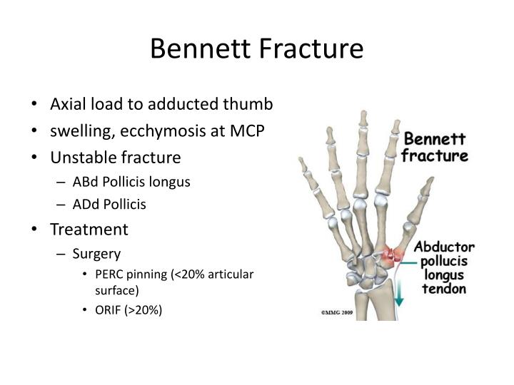 PPT - Sports-Related Hand and Wrist Injuries PowerPoint Presentation ...