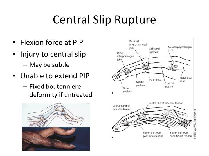 PPT - Sports-Related Hand and Wrist Injuries PowerPoint Presentation ...