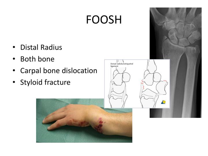 PPT - Sports-Related Hand and Wrist Injuries PowerPoint Presentation ...