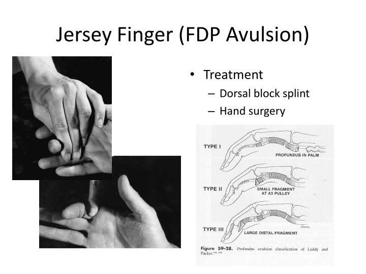 PPT - Sports-Related Hand and Wrist Injuries PowerPoint Presentation ...