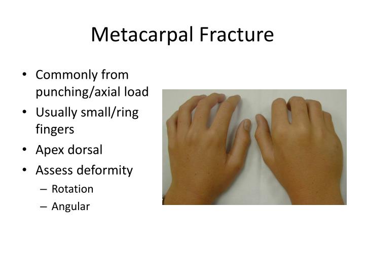 PPT - Sports-Related Hand and Wrist Injuries PowerPoint Presentation ...