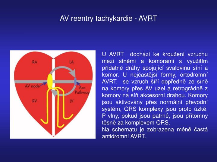 PPT - EKG – tachykardie (1.část) PowerPoint Presentation - ID:4846578