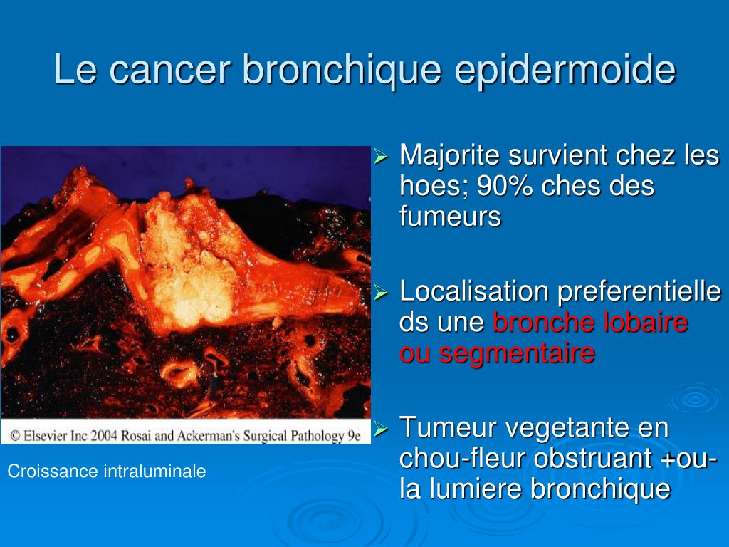 Ppt Cancers Bronchopulmonaires Powerpoint Presentation Free Download
