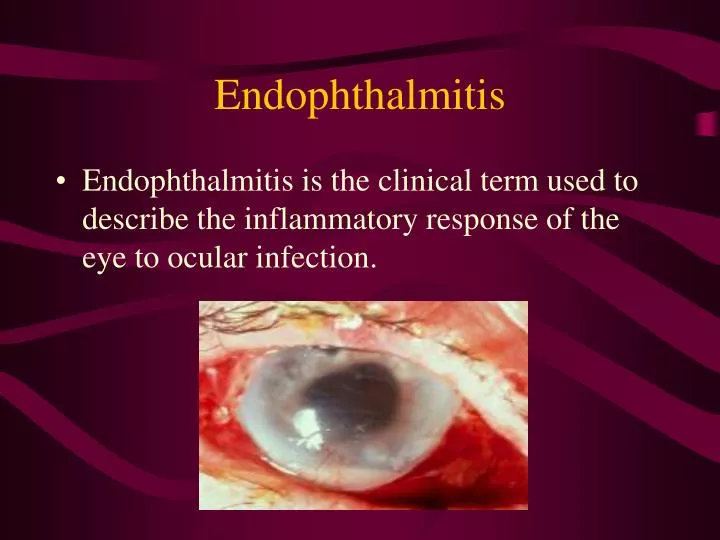 PPT - Endophthalmitis PowerPoint Presentation - ID:4853108