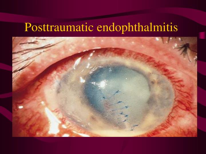 PPT - Endophthalmitis PowerPoint Presentation - ID:4853108