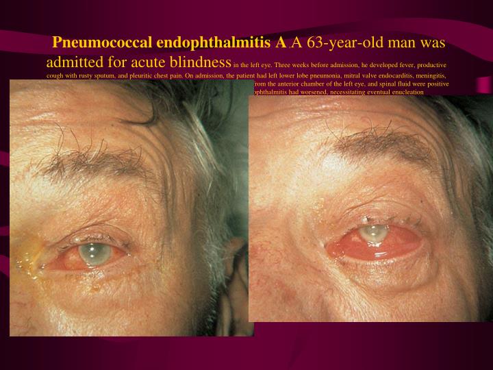 PPT - Endophthalmitis PowerPoint Presentation - ID:4853108