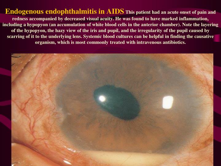PPT - Endophthalmitis PowerPoint Presentation - ID:4853108