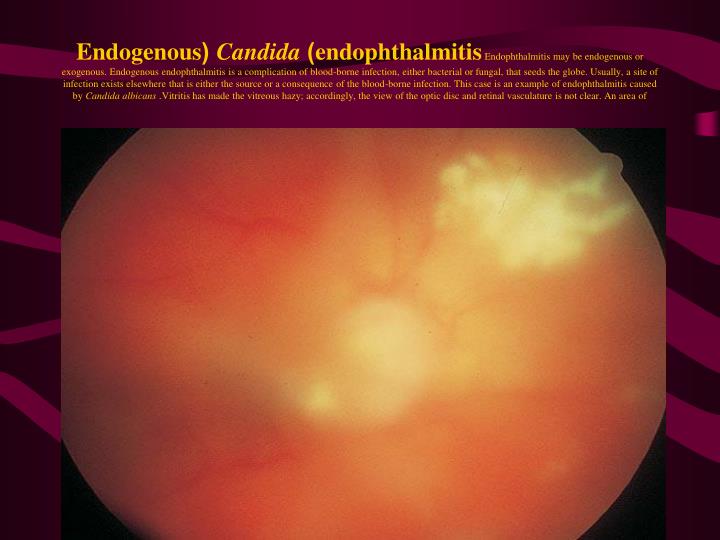 PPT - Endophthalmitis PowerPoint Presentation - ID:4853108
