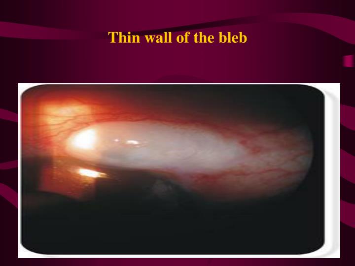 PPT - Endophthalmitis PowerPoint Presentation - ID:4853108