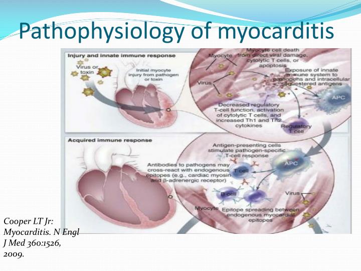 PPT - VIRAL MYOCARDITIS PowerPoint Presentation - ID:4854624