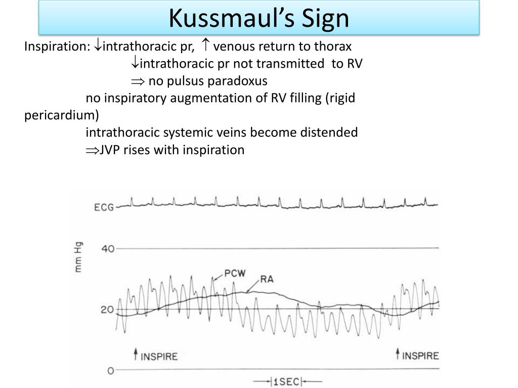 PPT - Haemodynamics of pericardial diseases PowerPoint Presentation ...
