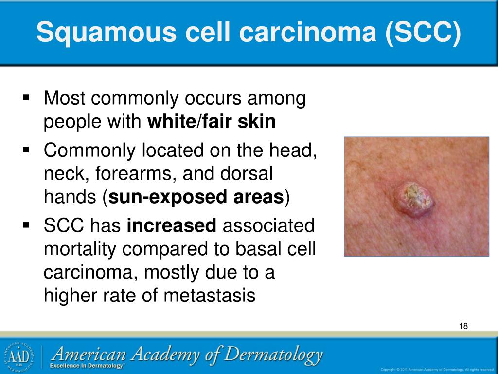 Ppt Actinic Keratosis And Squamous Cell Carcinoma Powerpoint
