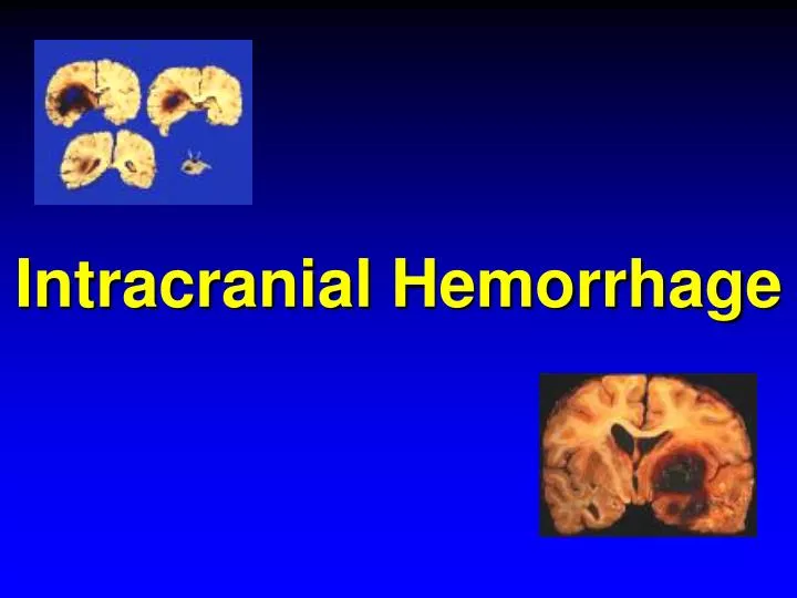 PPT - Intracranial Hemorrhage PowerPoint Presentation, free download ...