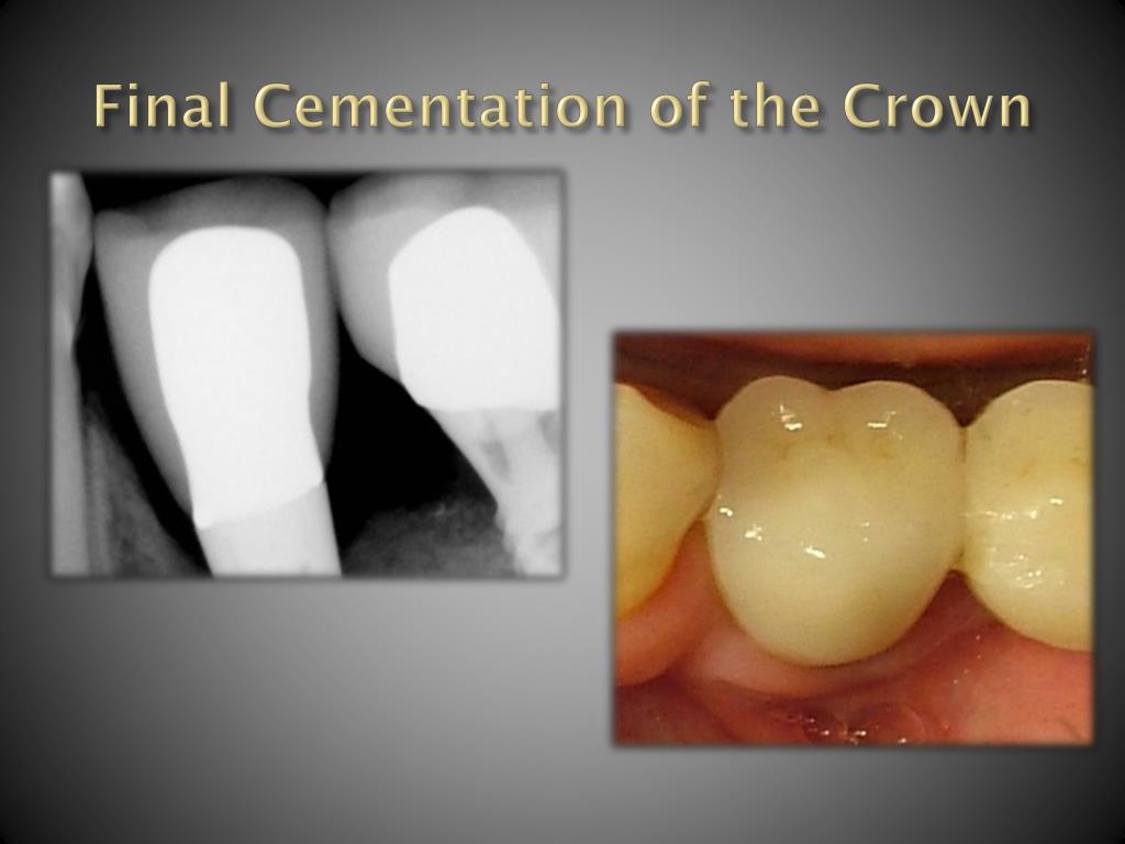 PPT - Clinical case Tooth #20 , Large periapical Pathology (x-ray) Pain ...