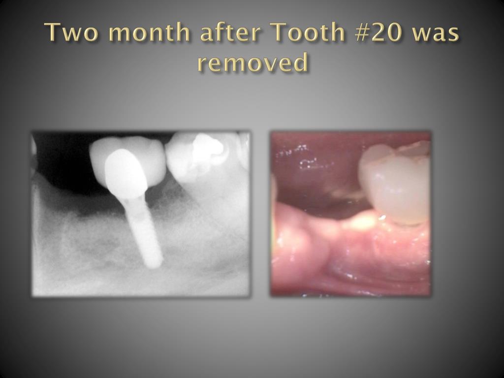 PPT - Clinical case Tooth #20 , Large periapical Pathology (x-ray) Pain ...