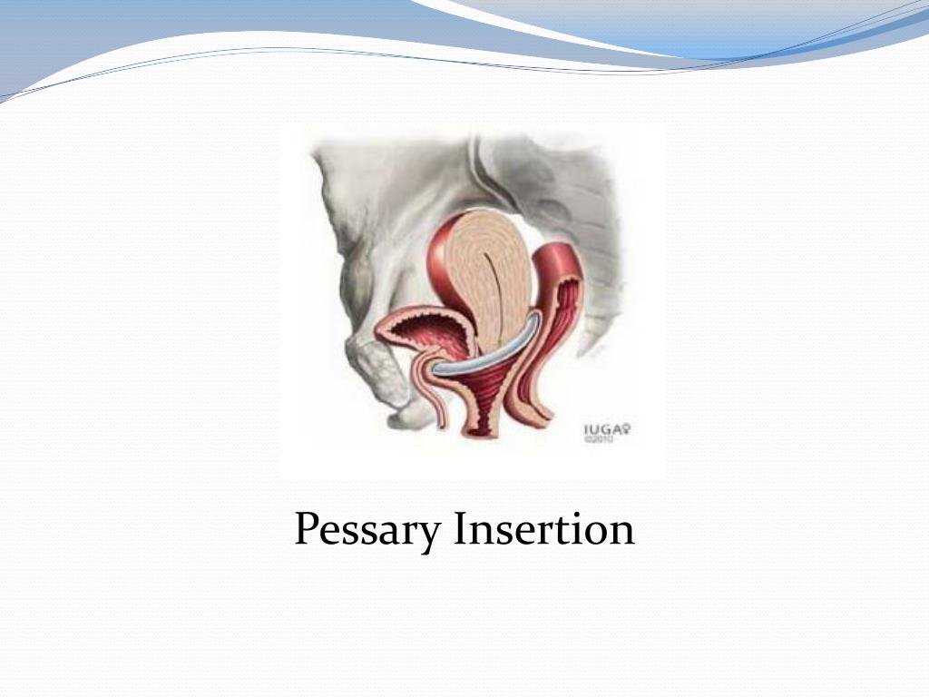 Ppt Pelvic Organ Prolapse Powerpoint Presentation Free Download Id