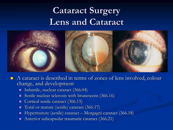 PPT - CATARACT SURGERY PowerPoint Presentation - ID:4867582