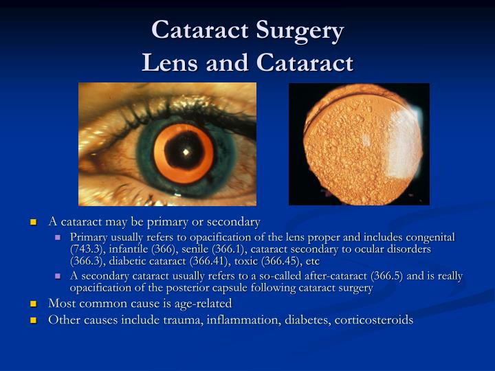 PPT - CATARACT SURGERY PowerPoint Presentation - ID:4867582