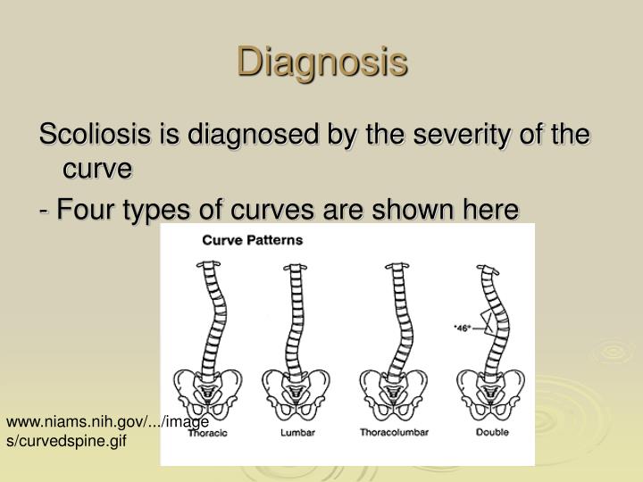 PPT - Scoliosis PowerPoint Presentation - ID:4874282